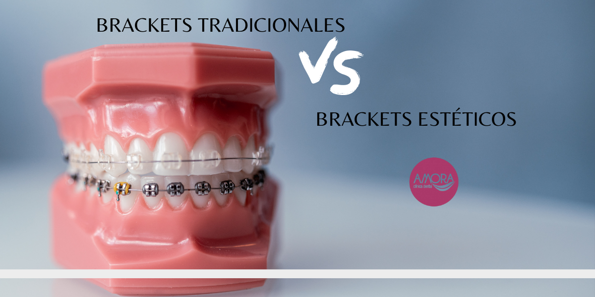 Brackets tradicionales vs brackets estéticos - Amora Clínica Dental